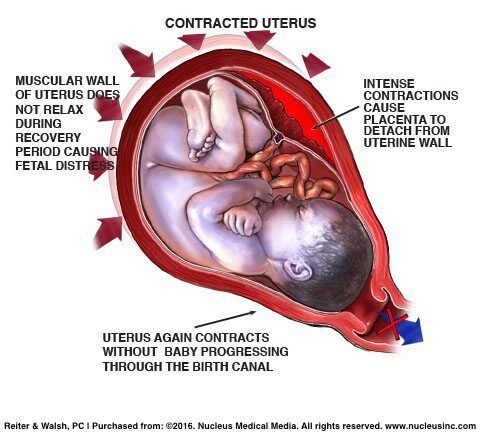 Cytotec (Misoprostol) and Labor Injuries